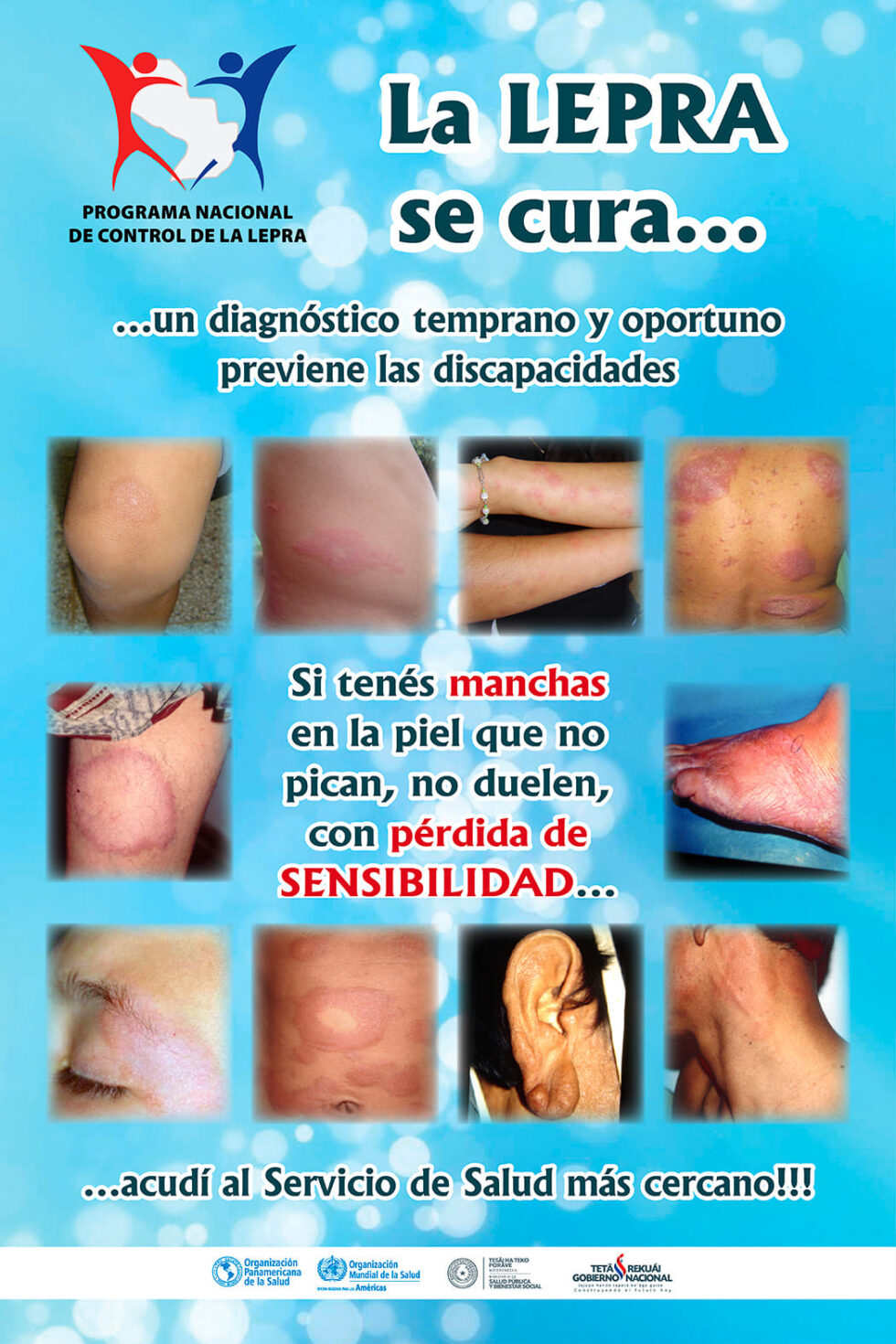 Programa Nacional de Control de la Lepra - DGVS